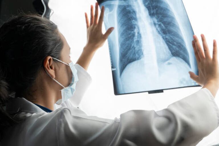 ¿Cuáles son los síntomas de la inflamación pulmonar y de qué enfermedad ...